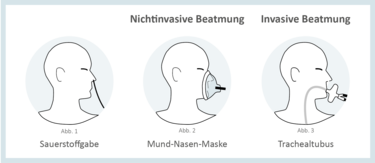 Anästhesiologie: Beatmung Corona-Patient*Innen | UMG